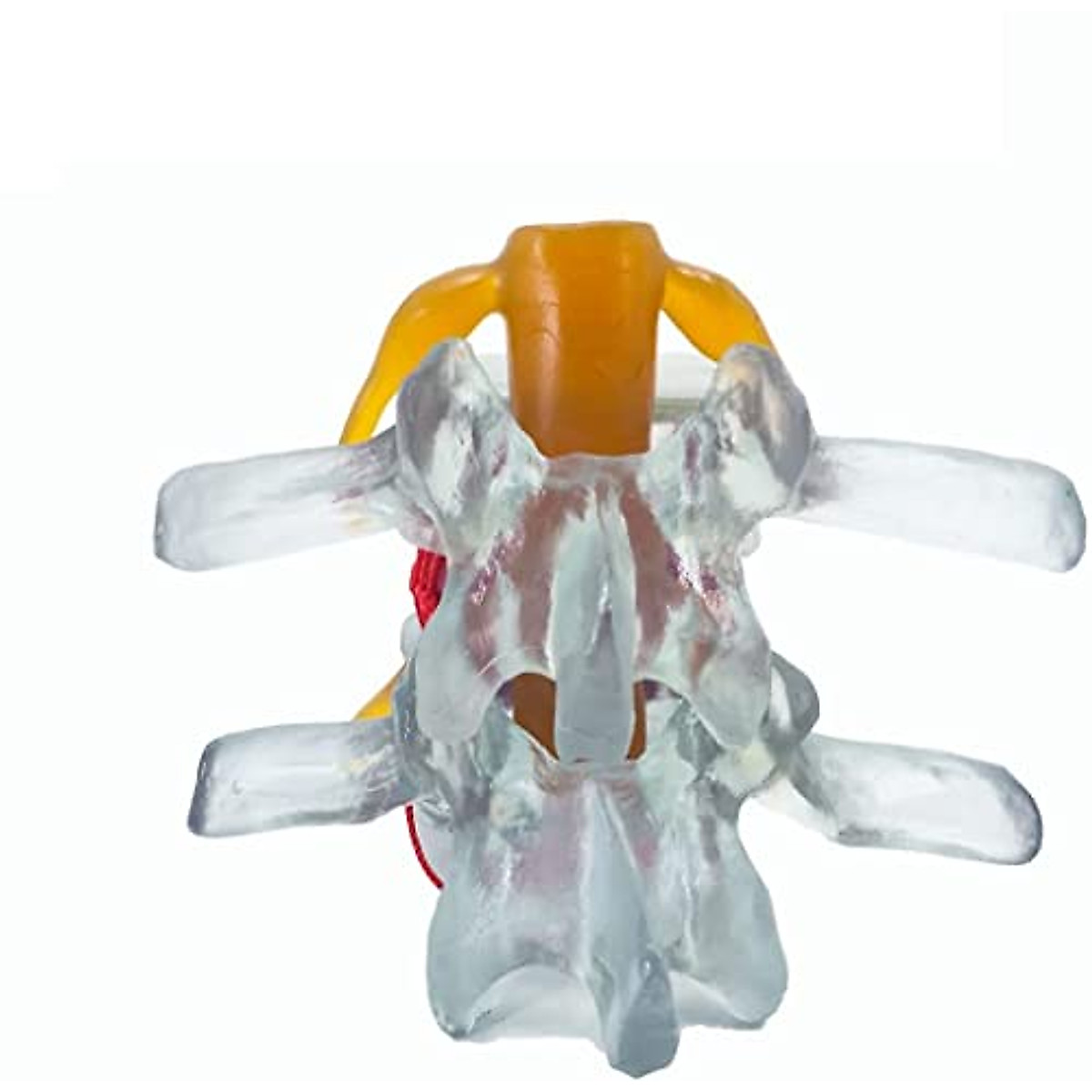 DenFactory Human 1.5 Times Life-Size Transparent Lumbar Disc Herniation Spine Model for Teaching and Learning