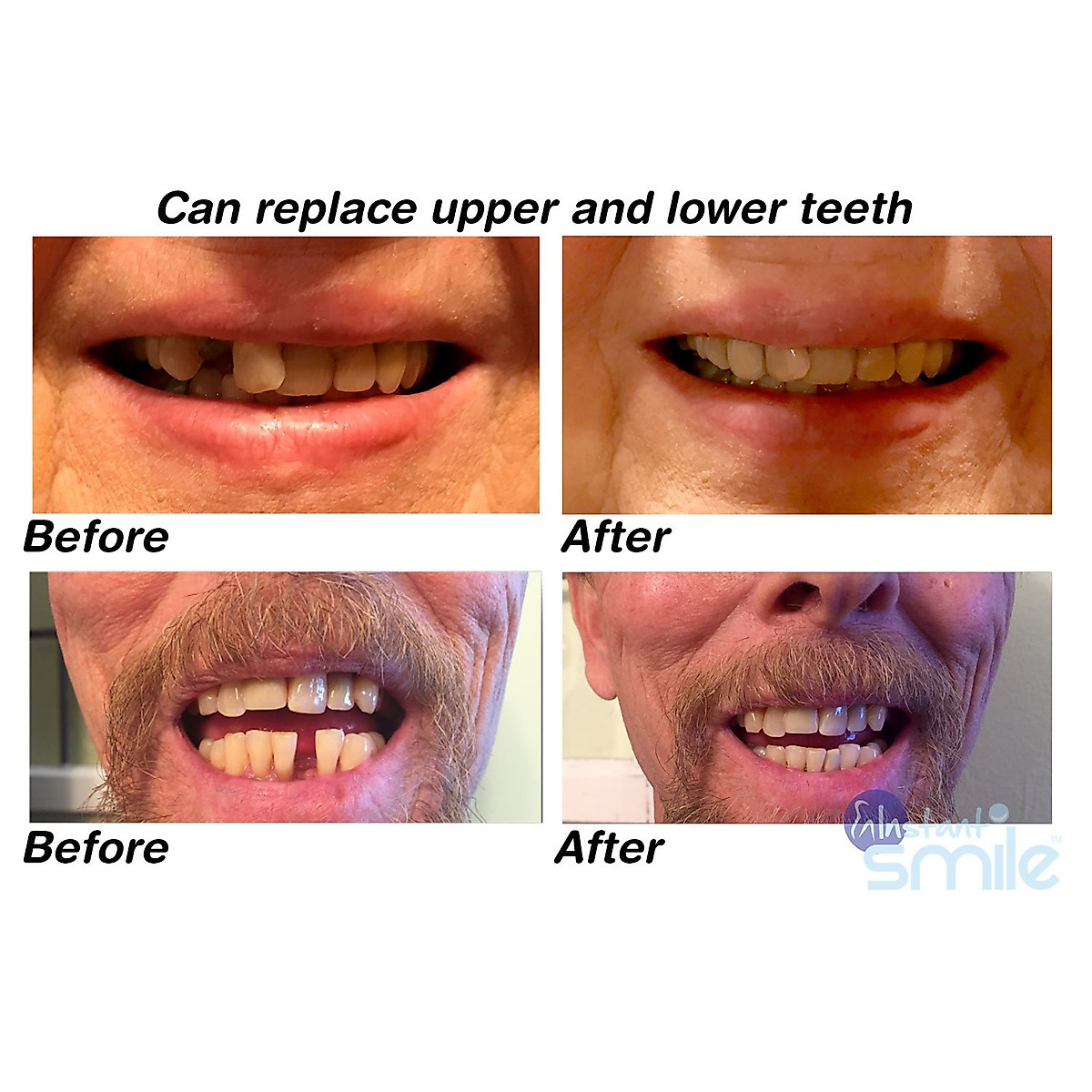 Instant Smile MULTISHADE Patented Temporary Tooth Repair Kit. A Realistic Looking Fix for a Missing or Broken Tooth.