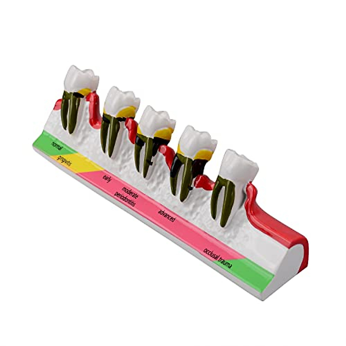 Ultrassist Dental Periodontal Disease Model, Dental Teeth Model for Dental Tooth Anatomy Study, Doctor-Patient and Oral Care Education
