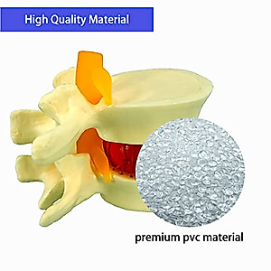 Veipho Human Anatomical Lumbar Disc Herniation Model, 1.5 Times Life Size Lumbar Disc Herniation Model, Human Lumbar Disc Herniation Model for Teaching, Learning, Demonstrating