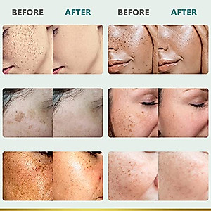 CITYGOO Dark Spot Remover for Face and Body, Dark Spot Corrector Cream, Natural Ingredient,Enriching Skin Care For All Skin Tones - Sun Spot, Melasma, Freckle Remover & Blemish Reducer-1 FL OZ