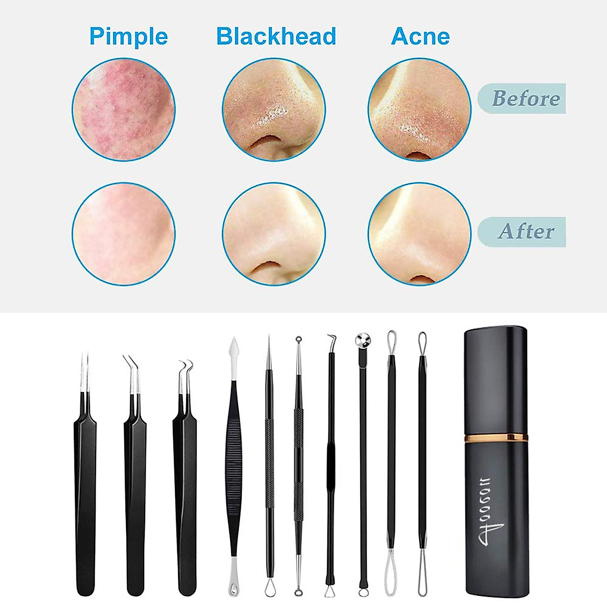 Pimple Popper Tool Kit, Aooeou 10 Pcs Professional Blackhead Extractor with Metal Case - Easy Removal for Pimples, Blackheads, Zit Removing, Forehead and Nose(Black)