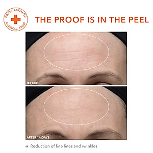 Dr. Dennis Gross Alpha Beta Ultra Gentle Daily Peel: for Dehydrated or Sensitive Skin, Uneven Tone or Texture, Fine Lines or Enlarged Pores (30 Treatments)