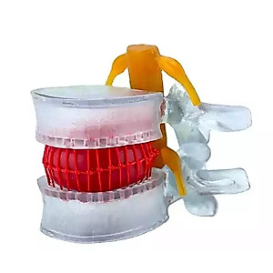 DenFactory Human 1.5 Times Life-Size Transparent Lumbar Disc Herniation Spine Model for Teaching and Learning