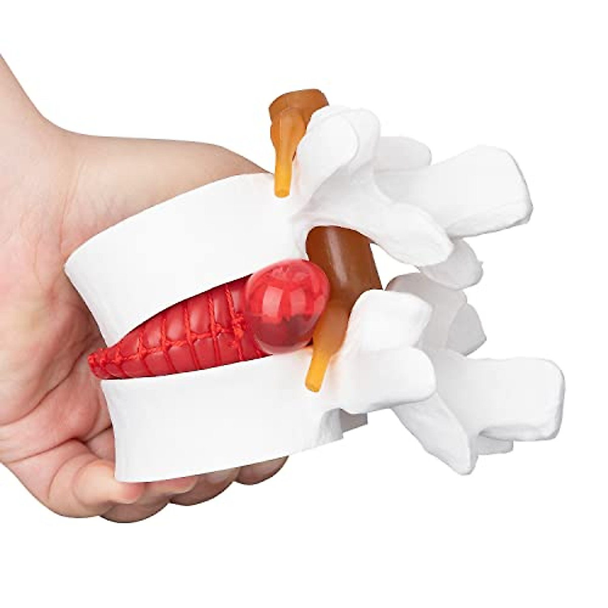 faruijie Disc Herniation Model - 1.5X Lumbar Herniated Disc Model Vertebral Spine Anatomical Medical Model