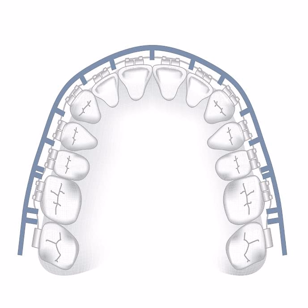 Comfort Cover for Braces, Lip Protector Mouth Guard Lip Cushion Teeth Shield Bumper for Brackets, Aligner, Dental Wax Alternative, Hard and Rigid Clip