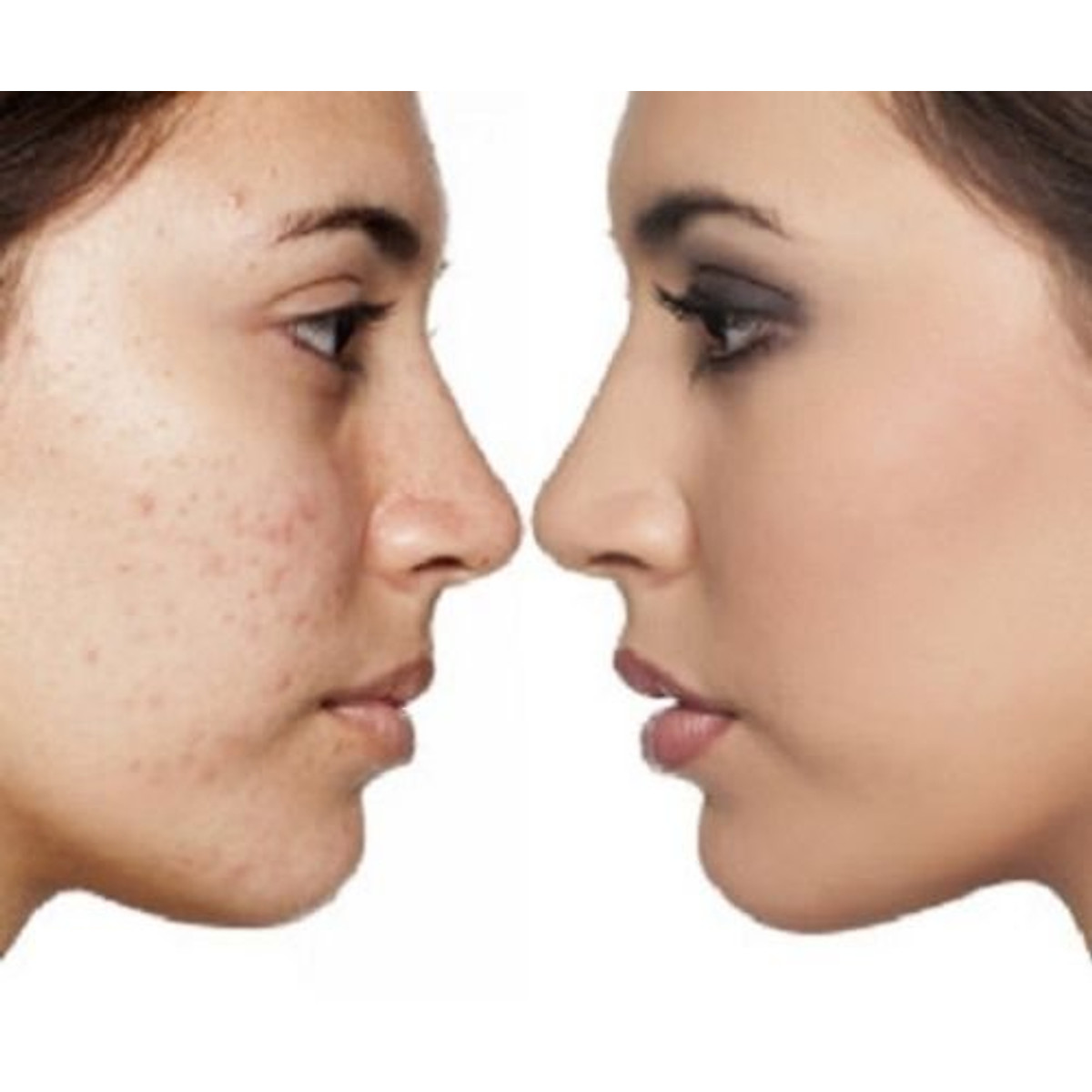 Clearskin Clear Blemish Clearing Spot Treatment Anti- imperfections 15ml, AVON