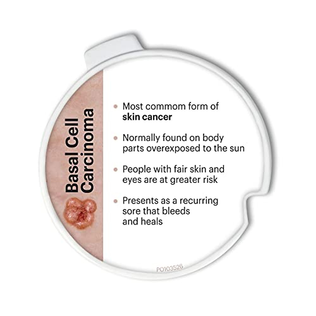 GPI Anatomicals - Skin Cancer Model, Replica with Precancerous and Cancerous Skin Lesions for Human Anatomy and Physiology Education, Anatomy Model for Doctor's Office, Medical Study Supplies