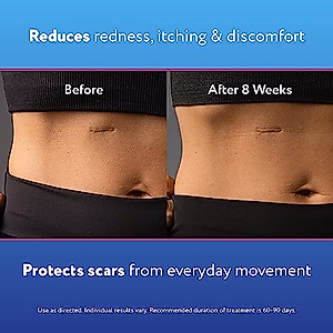 ScarAway Silicone Scar Gel, Helps Improve Size, Color & Texture of Hypertrophic & Keloid Scars from Injury, Burns & Surgery, Water Resistant, 10g (0.35 Oz)