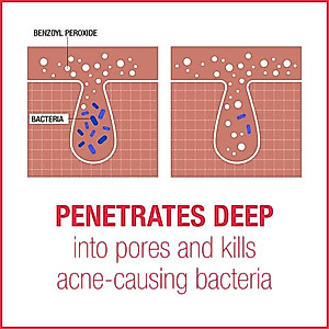Neutrogena Stubborn Acne AM Face Treatment with 2.5% Micronized Benzoyl Peroxide Acne Medicine, Oil-Free Daily Facial Treatment to Reduce Size & Redness of Breakouts, Paraben-Free, 2 oz