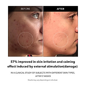 APRILSKIN Carrotene Clarifying Facial Serum | Vegan, Non-comedogenic | Blemish Clear, Dark Spot Corrector | Korea Skincare | Oily Skin, Sensitive Skin, Bumpy Skin | 1.25 fl.oz