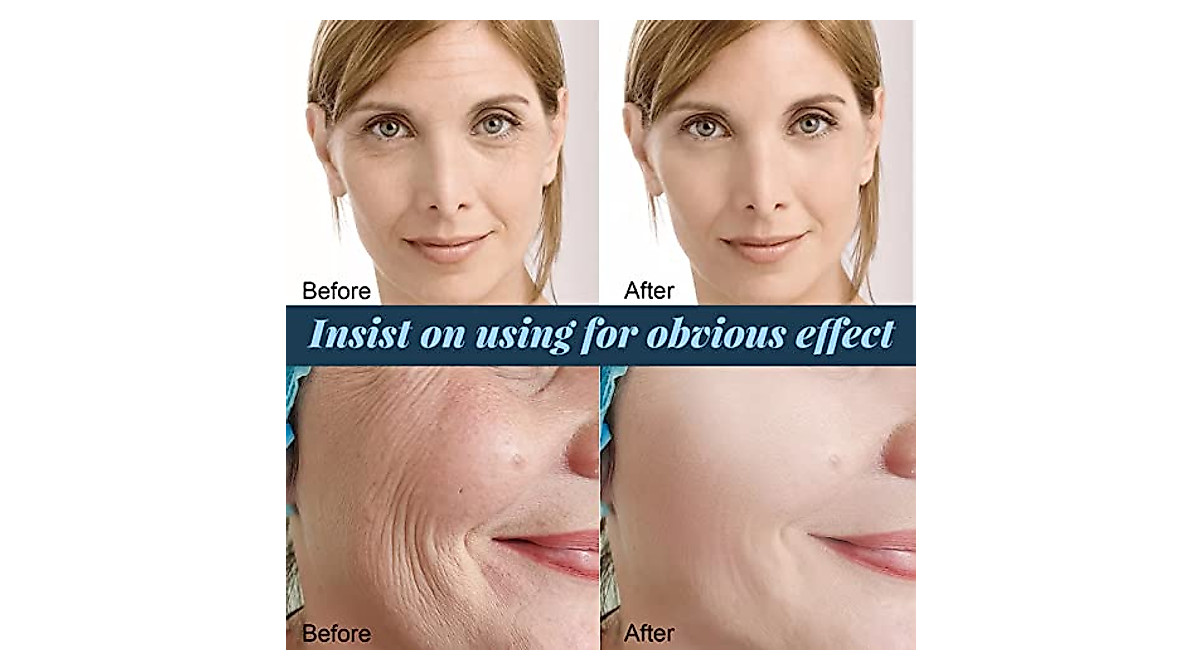 Proform Korean Protein Thread - Instant Face Lift (60PCS)