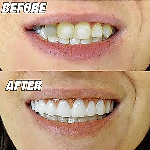 Fake Teeth, 2 PCS Veneers Dentures Socket for Women and Men, Dental Veneers for Temporary Tooth Repair Upper and Lower Jaw, Protect Your Teeth and Regain Confident Smile, Professional Cosmetic (2)