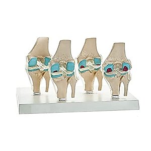 Spancare 4 Stage Osteoarthritis Anatomical Knee Model, Model On Base, with Detailed Study