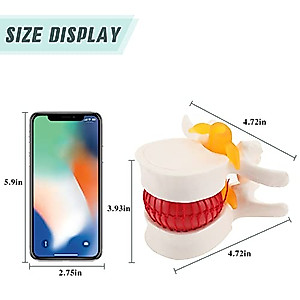 RONTEN Lumbar Disc Herniated Model, Human Anatomical Lumbar Spine Model for Medical Teaching & Learning