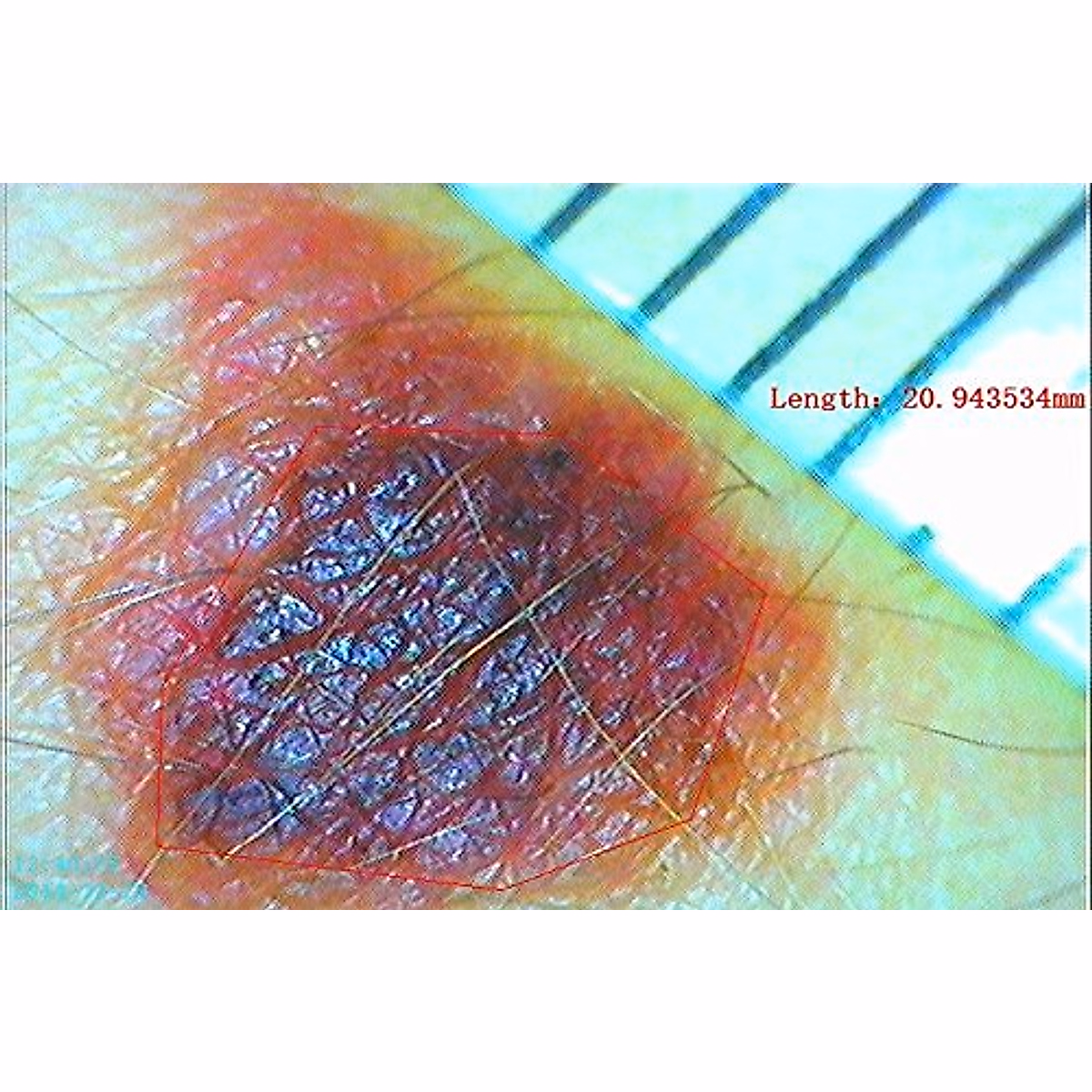 Firefly DE350 Wireless Polarizing Dermatoscope