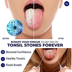 ORAVIX Tonsil Stone Removal Kit - Tonsil Stone Remover - Fast Painless Tonsillolith Remover Tool - Tonsil Cleaner - Fight Bad Breath - Tonsil Stone Removal - Oral Irrigator - Tongue Scraper - 7 Pieces