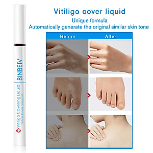 BINBEIV Vitiligo Cosmetic Camouflage Liqui, Cover appearance of Skin Depigmentation, Natural-Durable-Waterproof, Makeup Cover Waterproof, Used on face, hands and body