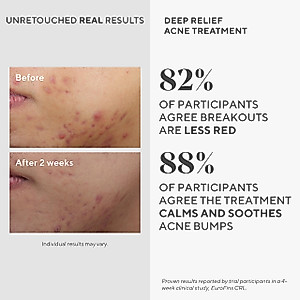 Murad Deep Relief Acne Treatment - Acne Control Max Strength 2% Salicylic Acid, Healing Treatment for Deep, Uncomfortable Acne, 1 Fl Oz