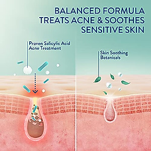 Cetaphil Acne Face Wash, Gentle Clear Clarifying Acne Cream Cleanser with 2% Salicylic Acid, Deep Cleans & Treats Acne Prone Skin, Skin Care for Sensitive Skin, 4.2oz