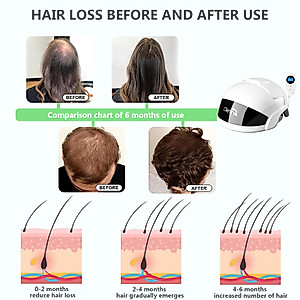 CLETINA Laser Hair Growth System - Hair Loss Treatments For Hair Regrowth - Ideal for Thinning Hair Treatment by Using Red Light and Laser Therapy
