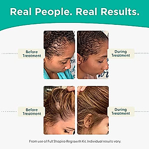 Women’s Hair Regrowth Travel Kit: Leave-In Foamer, 2% Minoxidil. Experience Healthier, Fuller, and Thicker looking Hair with Shapiro MD