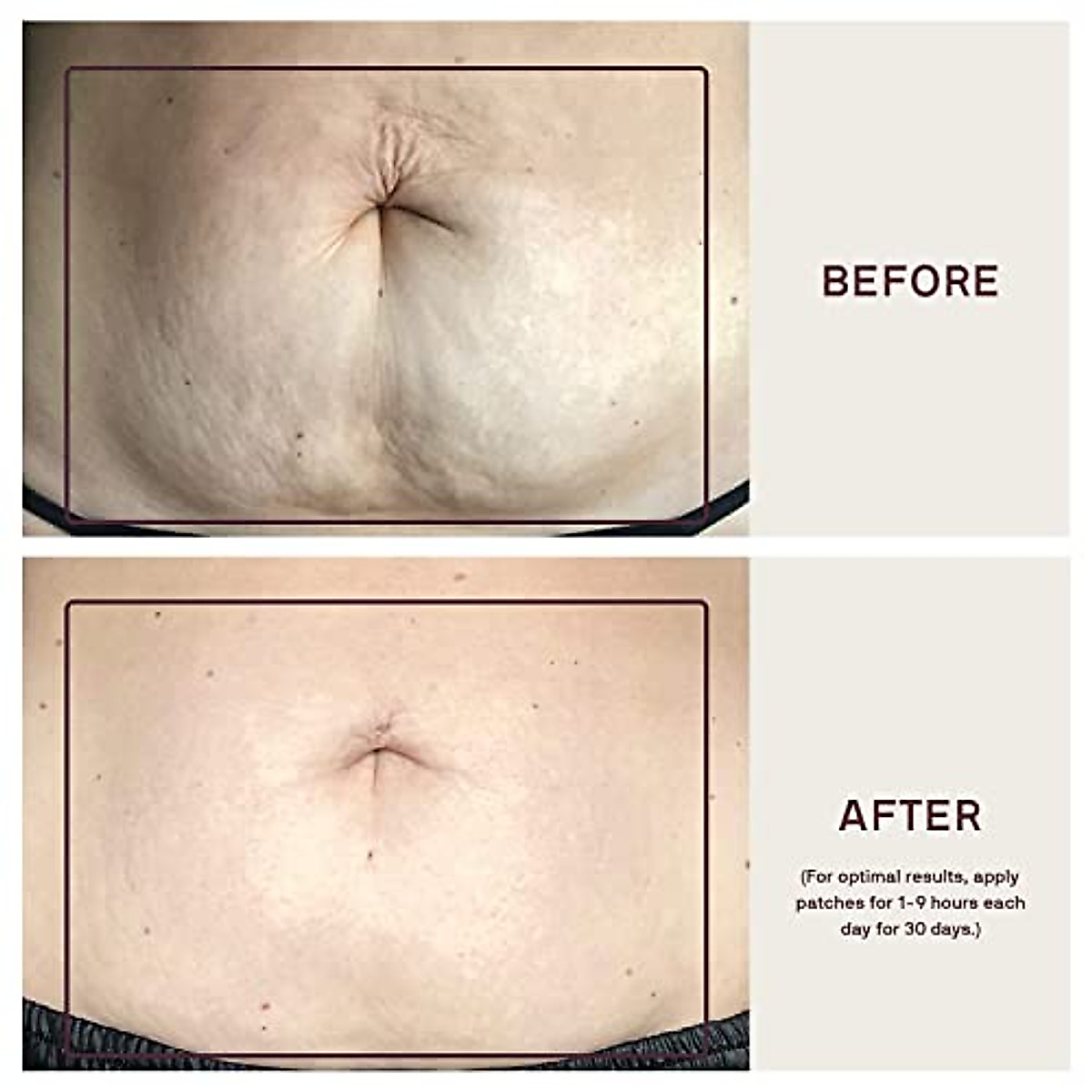 Dermaclara Large Body Patch - Pregnancy Stretch Mark Prevention & Removal, C Section Cover Up Belly Scar, Maternity Skincare, Silicone Gel Sheet, Reusable up to 30 Times - 2 Patches & Patch Cleanser