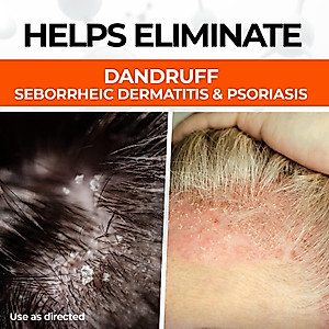 Medicasp Coal Tar Gel Anti Dandruff Shampoo, Treats Seborrheic Dermatitis & Psoriasis, Formulated for Dry, Flaky & Itchy Scalp Treatment, for Women & Men, 6 Ounce (Pack of 3)