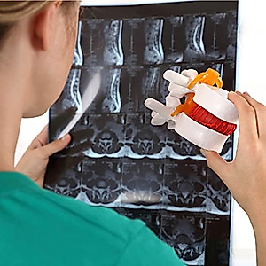 RONTEN Lumbar Disc Herniated Model, Human Anatomical Lumbar Spine Model for Medical Teaching & Learning