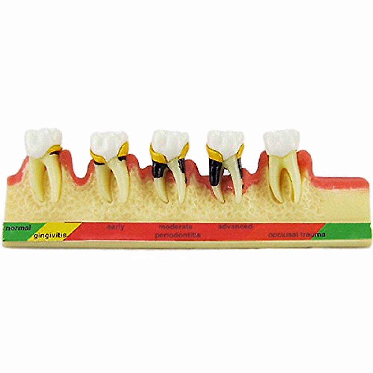 Dental Periodontal Disease assort Tooth Teeth Typodont Study Teaching Model New