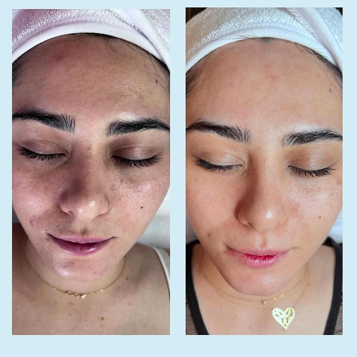 Salicylic Gel Chemical Peel - Enhanced with Green Tea Extract and Tea Tree Oil (20% Strength)