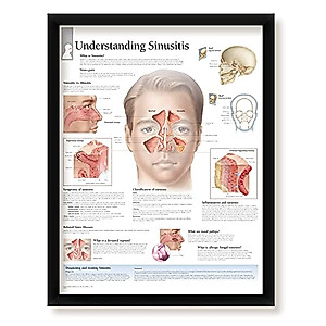 Set of 4 Framed Medical Posters Ear, Nose and Throat, Understanding Sinusitis, Understanding Rhinitis, and Middle Ear Infections 22"x28" Wall Diagrams