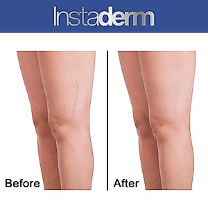 Instaderm Vitamin K Cream- Bruise Healing Formula with Arnica. Dark Spot Moisturizer for Bruising, Spider Veins & Broken Capillaries. Repair Under Eye Dark Circles, & Puffiness.