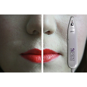 Verseo Permanent Hair Removal Conductive Patches for the Body, Leg, Stomach, Bikini Line, Perfect Shaving Alternative for Men and Women with Sensitive Skin (Large Body Patch)