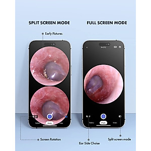 Anykit Wireless Otoscope Ear Camera with Dual View, 3.9mm 720PHD WiFi Ear Scope with Ear Wax Removal Tool for Kids and Adults & Pets, Compatible with Android and iPhone