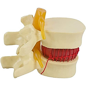 1PCS Anatomical Human Lumbar Vertebrae Degenerative Lumbar Human Spine Model (Yellow)