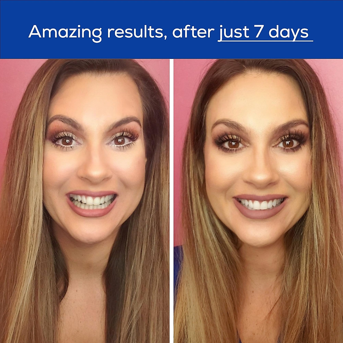 GLO Science Teeth Whitening Gel – 6% Hydrogen Peroxide – Clinically Proven, Fast & Safe for Sensitive Teeth – Includes 10 Gel Vials & 1 Lip Care