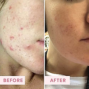 Sand & Sky Australian Pink Clay Porefining Mask for Blackheads, Enlarged Pores and Pigmentation