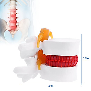 ASINTOD Human Anatomy Lumbar Disc Herniation Model,A Model Showing The Anatomy of Human Lumbar Disc, An Excellent Choice for Teaching and Learning The Human Lumbar Spine