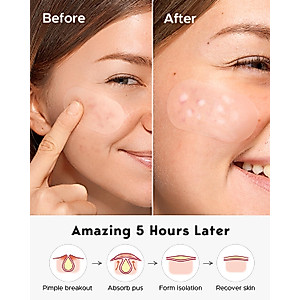 LitBear Large Acne Pimple Patches, 5 Sizes 80 Patches for Large Breakouts, Acne Patches for Face, Chin or Body, Acne Spot Patch with Tea Tree & Calendula Oil, Hydrocolloid Bandages for Acne Skin