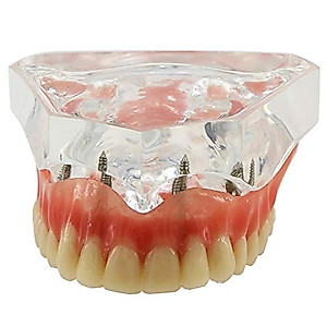 DENTALMALL Dental Upper Implants Model Overdenture with 4 Superior Teeth Demo Transparent Vision for Education and Study Model Tool M6001 C