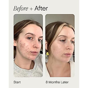 Topicals Faded Skin Serum for Dark Spots and Discoloration - Hyperpigmentation Safe - Tranexamic Acid and Niacinamide for Post-Blemish Marks, Scars and Spots (1.7 Fl Oz)