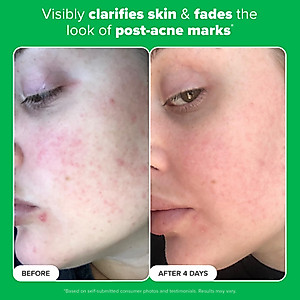 Paula’s Choice BOOST 10% Azelaic Acid Booster Cream Gel, Oil-Free Serum Fades Discoloration & Post-Blemish Marks, with Licorice Extract & Salicylic Acid, Fragrance-Free, 0.17 Fl. Oz.