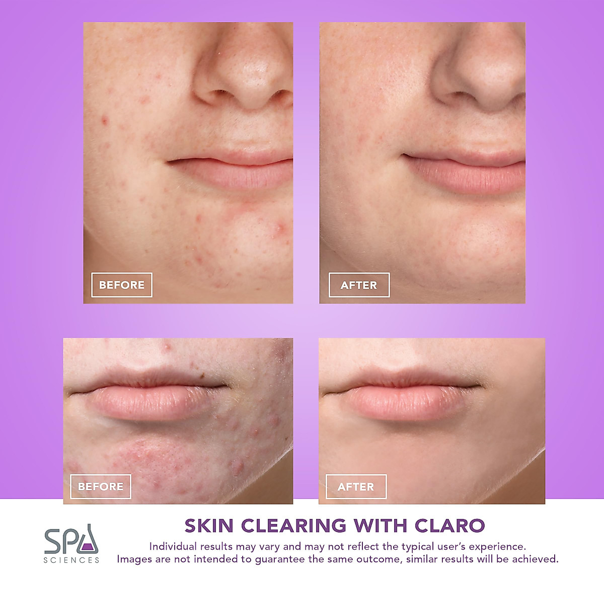 Spa Sciences CLARO Clinically Proven Blue & Red LED Acne Treatment Light Therapy System-FDA Cleared-Rechargeable- Professional Home Acne Healing/Clearing Treatment