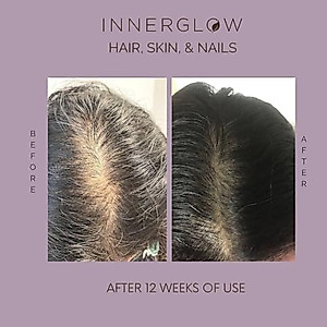 Inner Glow Advanced Hair, Skin & Nails Formula - Dermatologist and Plastic Surgeon Developed, clinically Tested for visibly Stronger and Thicker Hair in 12 Weeks