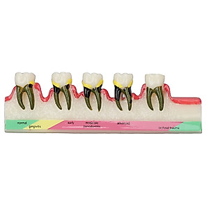 Natudeco Tooth Model Oral Care Model Denture Kit Strong Durable And Convenient. Teachers Use Order Remarks Product Box Plus Buffer Cotton Delivery