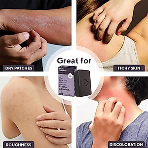 Marie Originals Eczema Face Soap Body Wash Bar – All Natural Psoriasis, Dermatitis Treatment for Dry Itchy Flaky Skin Relief – Gentle Detoxifying, Healing, Anti-Itch, Cleansing Skincare (Pack of 1)