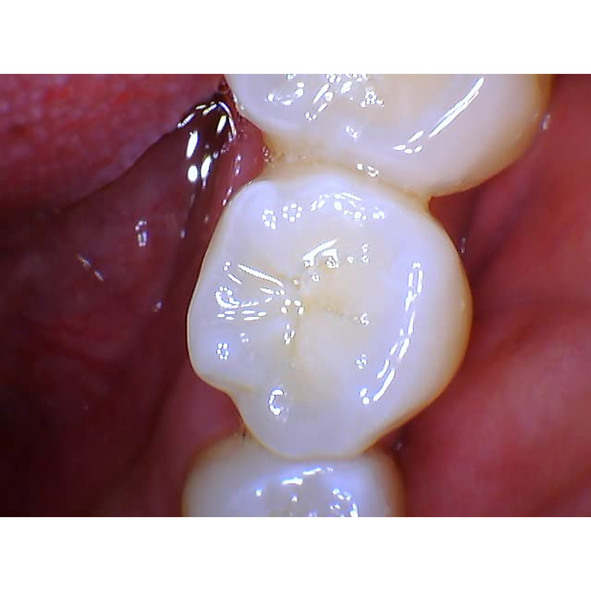 TELICAM Intraoral Camera Dental, Works with Eaglesoft, Dexis, Apeteryx, Carestream, Tigerview