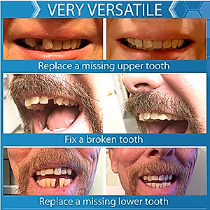 Instant Smile Complete Your Smile Temporary Tooth Replacement Kit - Replace a Missing Tooth in Minutes - Patented