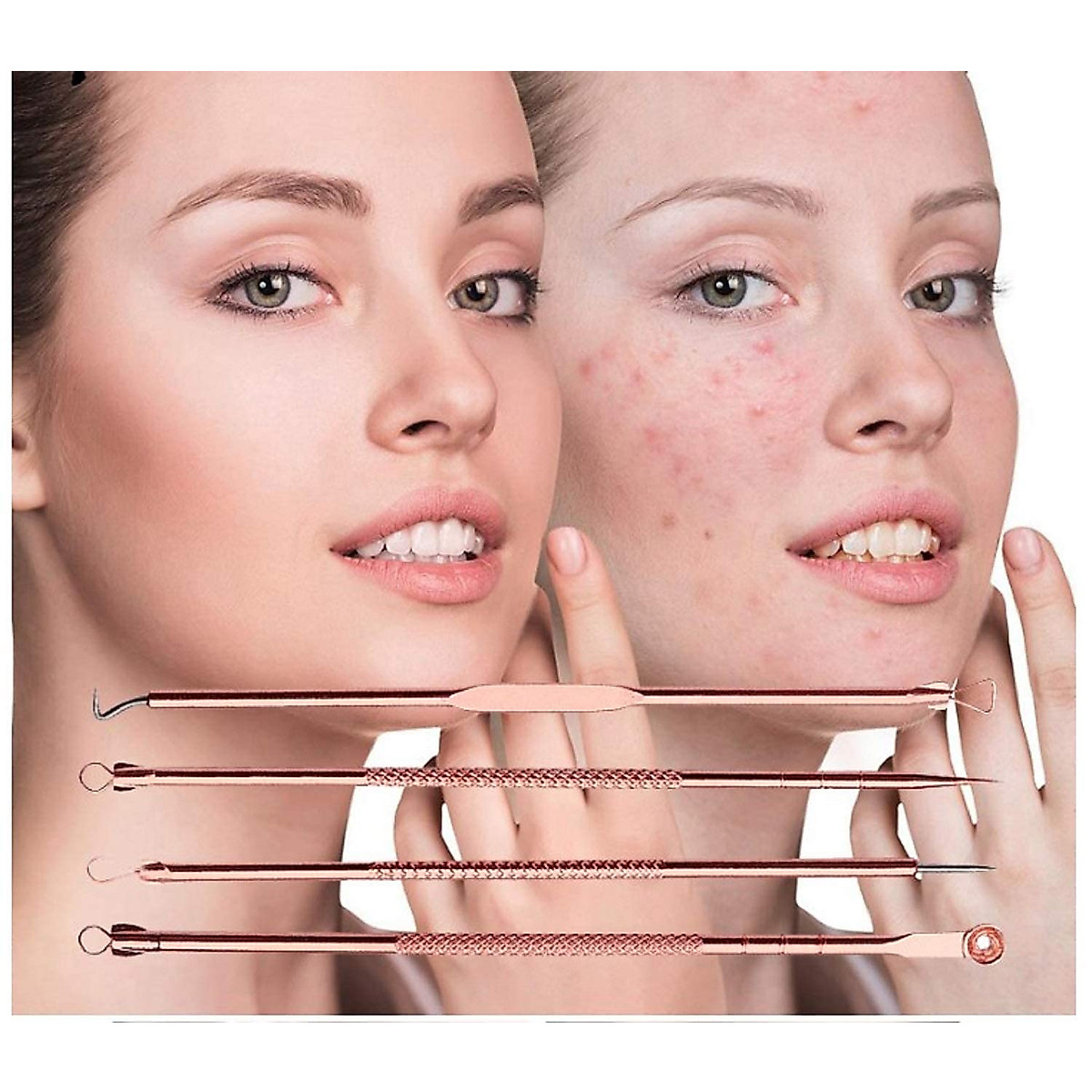 Blackhead Remover Pimple Comedone Extractor Tool, Effective Acne Removal Kit, Treatment for Blemish, Whitehead Pimple Popping, Zit Removing for Nose & Face Skin, Best Electroplated 4 PCS w/case.